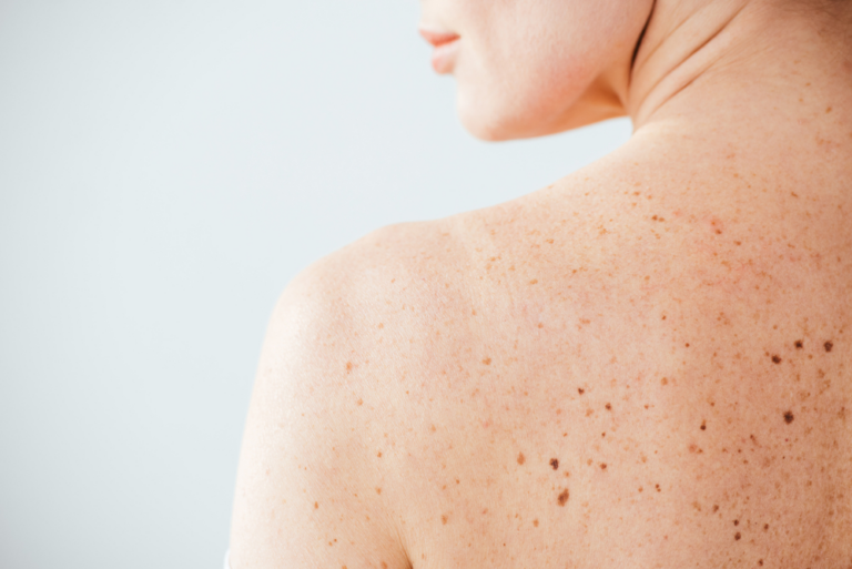 How Can You Recognize Abnormal Moles? - Charlotte NC - Steele Creek ...